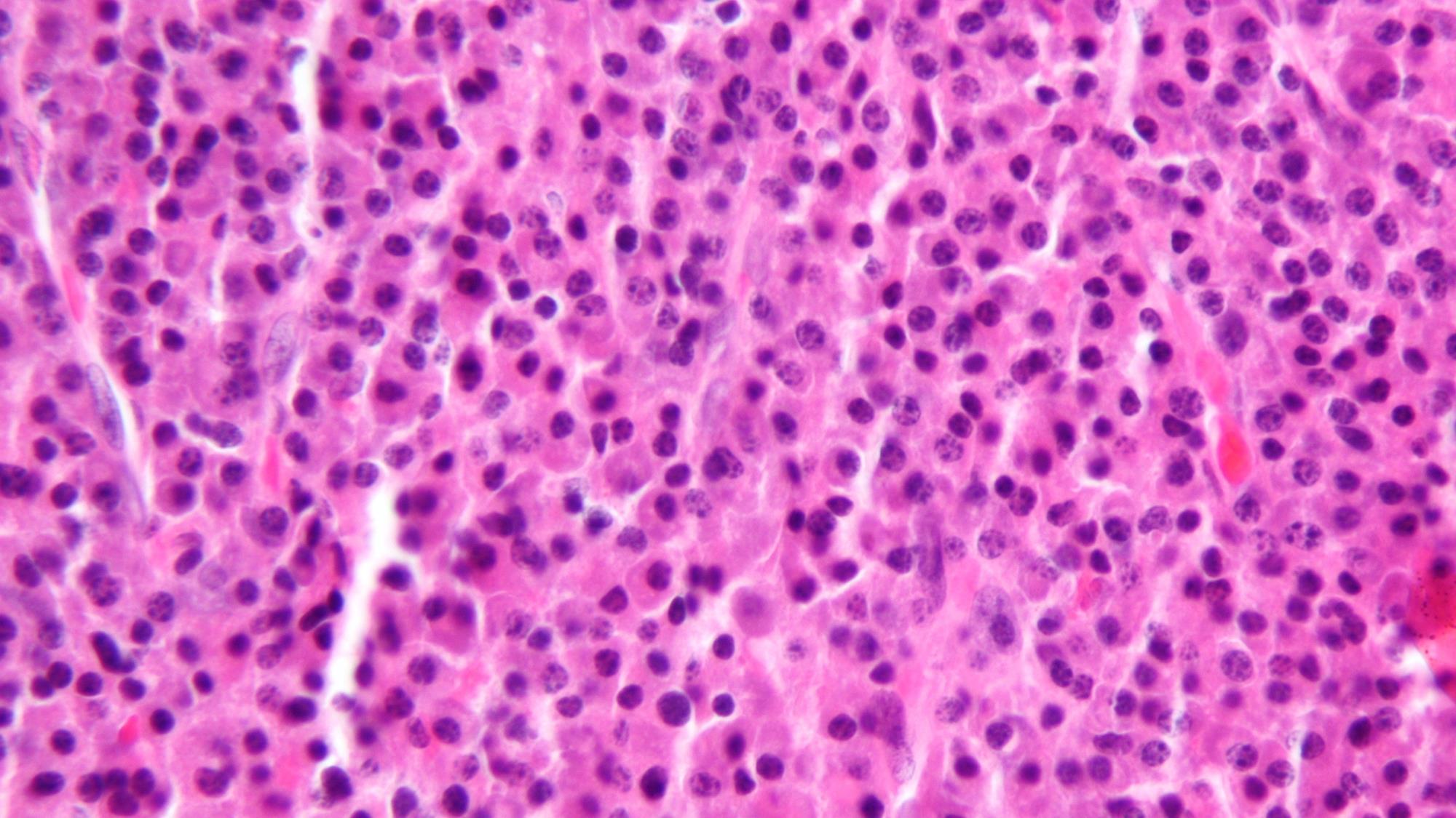 Bloedkanker beter behandelen met doelgerichte remmer | Industrie ...